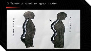 D5 Kyohotic disorder | PPTX