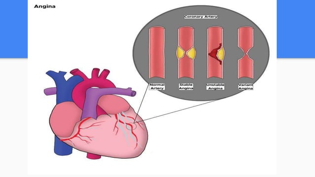 Unstable Angina.pptx | Heart and Cardiovascular Diseases | Diseases and Conditions