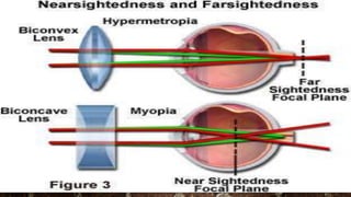 OPTICS OF HUMAN EYE , SCHEMATIC EYE, ANGLE AND AXES OF EYE | PPTX