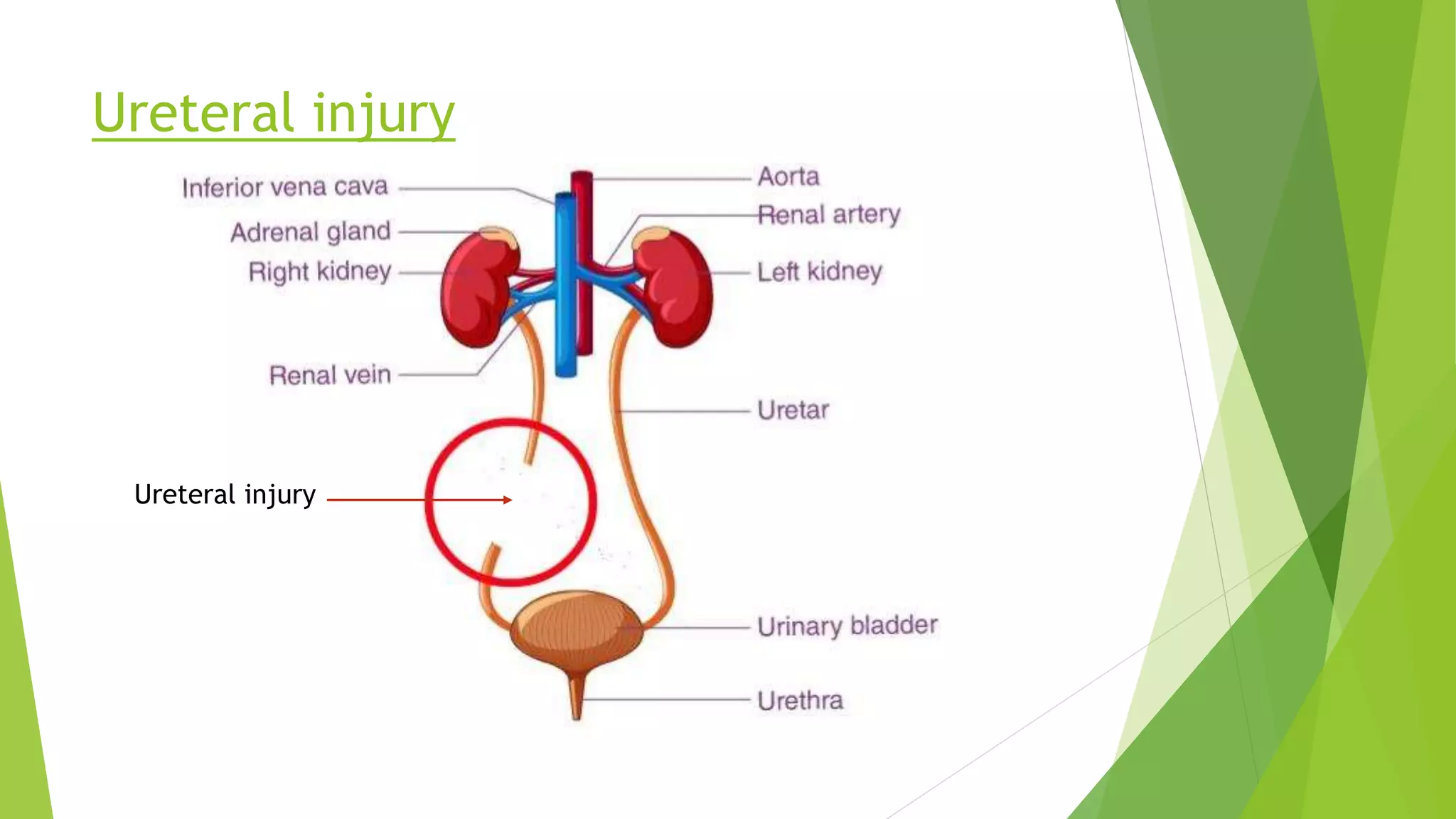 URETERAL INJURY.ppt