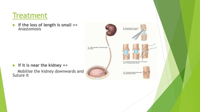URETERAL INJURY.ppt