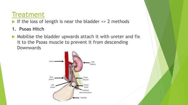 URETERAL INJURY.ppt