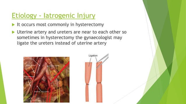 URETERAL INJURY.ppt