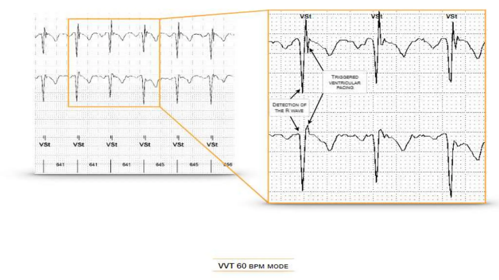 Permanent pacemaker cycle length. Managent | PPT | Free Download