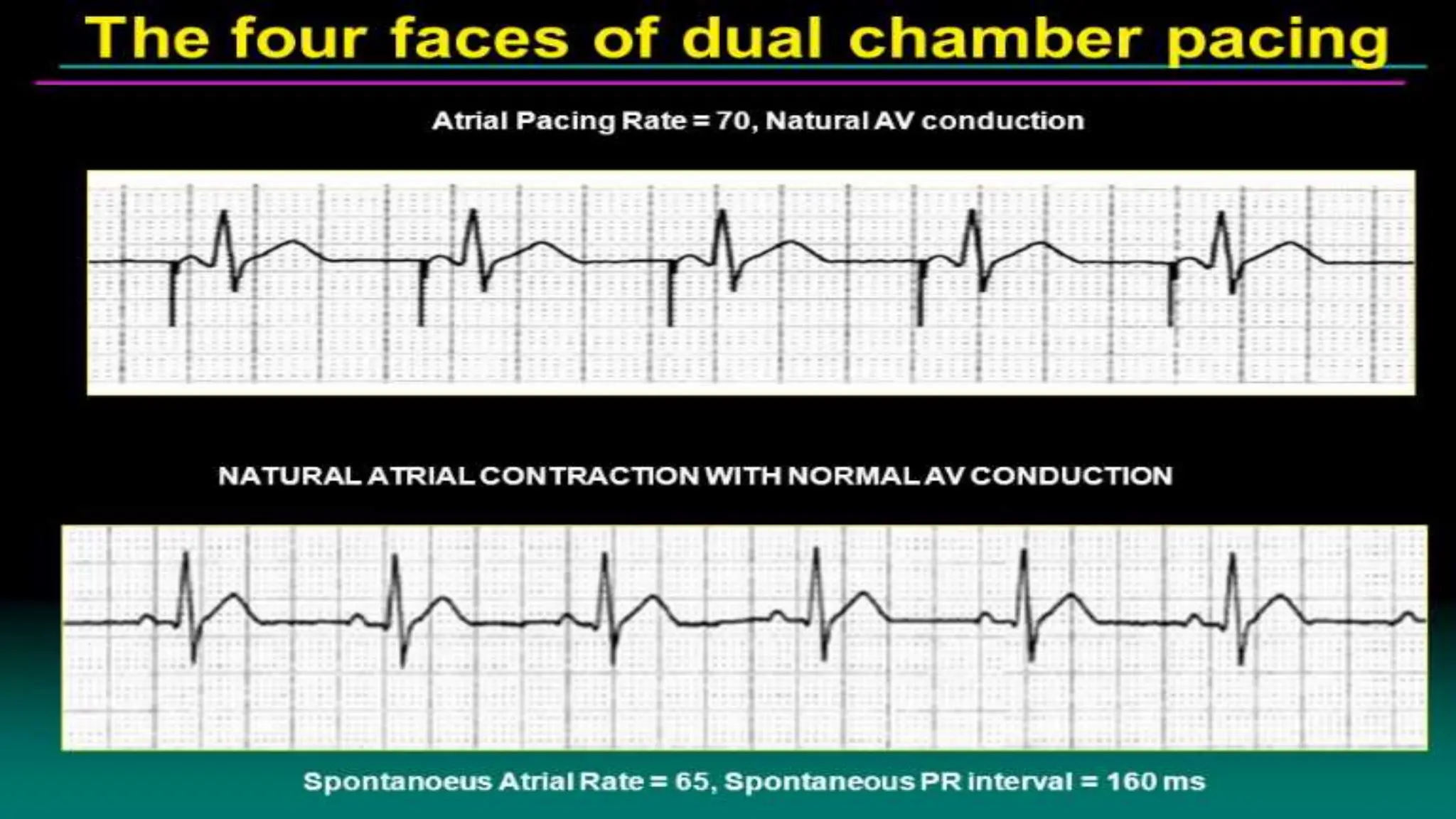 Permanent pacemaker cycle length. Managent | PPTX