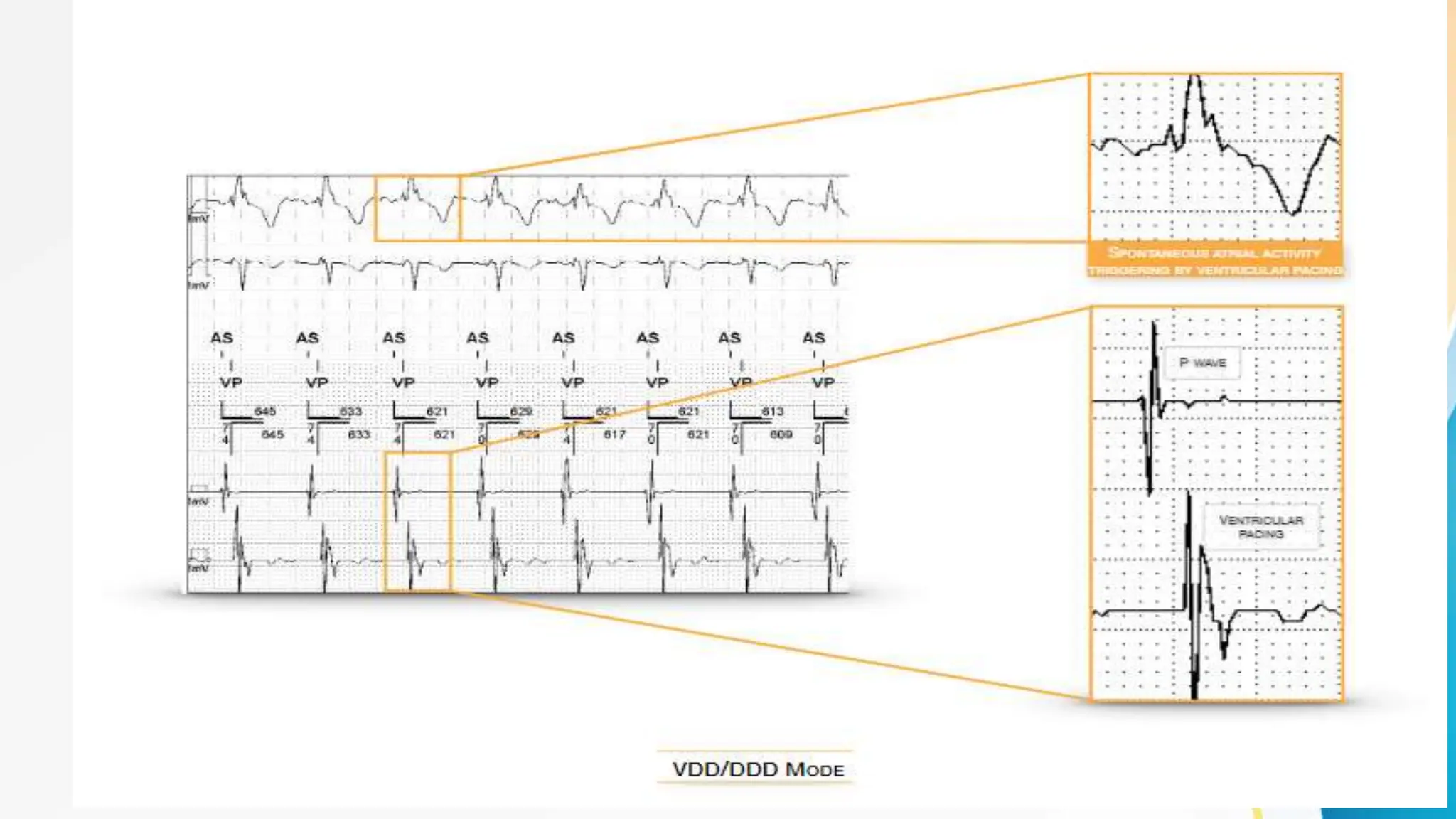 Permanent pacemaker cycle length. Managent | PPTX
