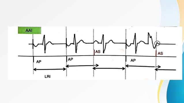 Permanent pacemaker cycle length. Managent | PPT | Free Download