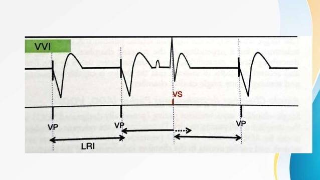 Permanent pacemaker cycle length. Managent | PPT | Free Download