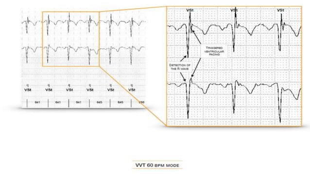 Permanent pacemaker cycle length. Managent | PPT