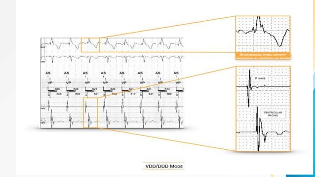 Permanent pacemaker cycle length. Managent | PPT