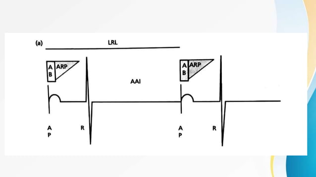 Permanent pacemaker cycle length. Managent | PPT | Free Download