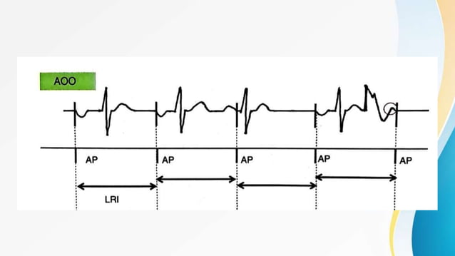 Permanent pacemaker cycle length. Managent | PPT | Free Download
