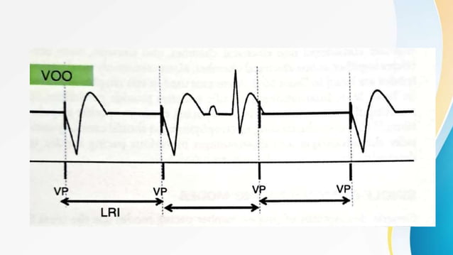 Permanent pacemaker cycle length. Managent | PPT | Free Download