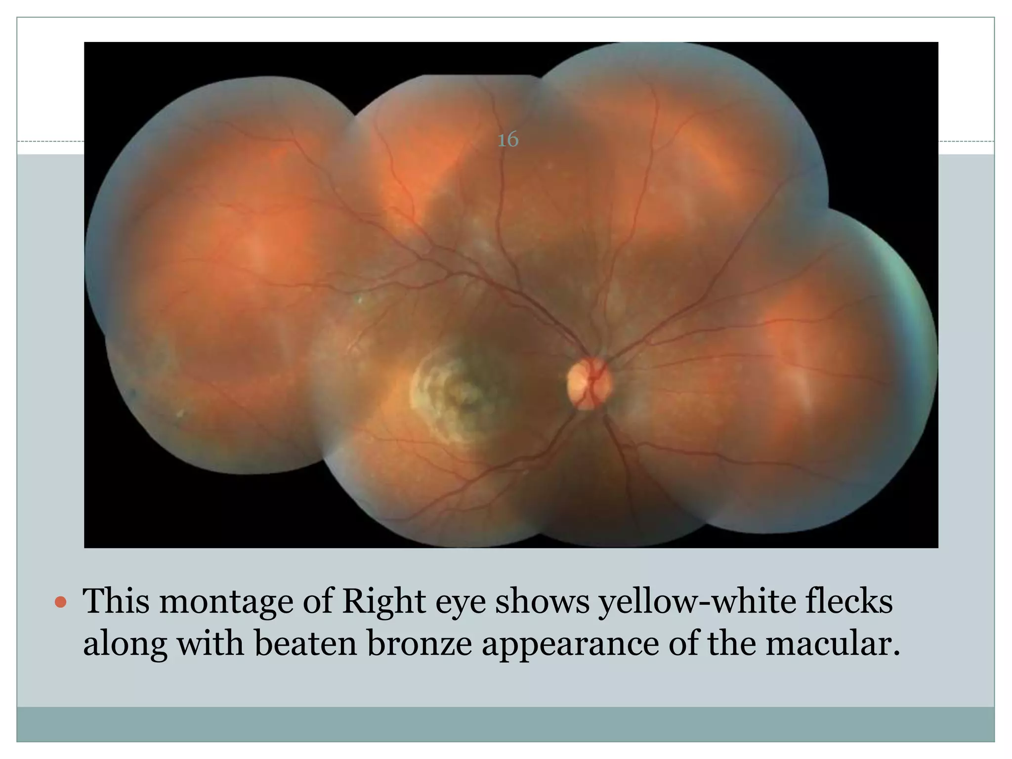 Stargardt disease and low vision management. | PPTX