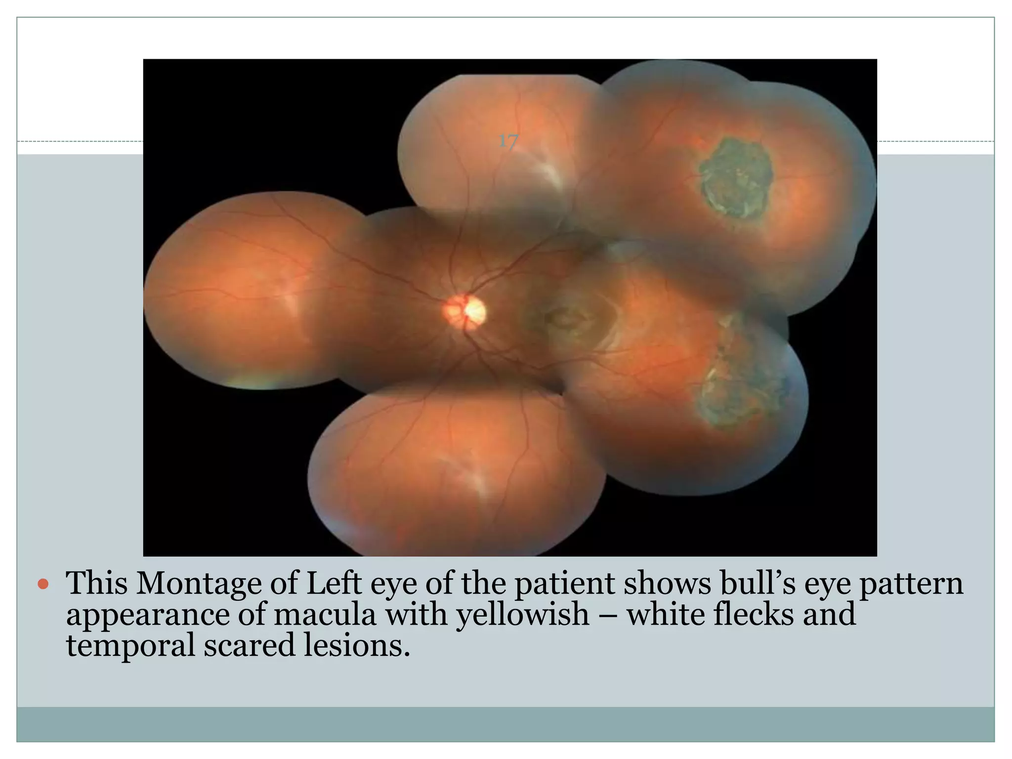 Stargardt disease and low vision management. | PPTX