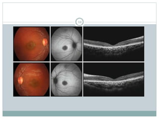 Stargardt disease and low vision management. | PPTX