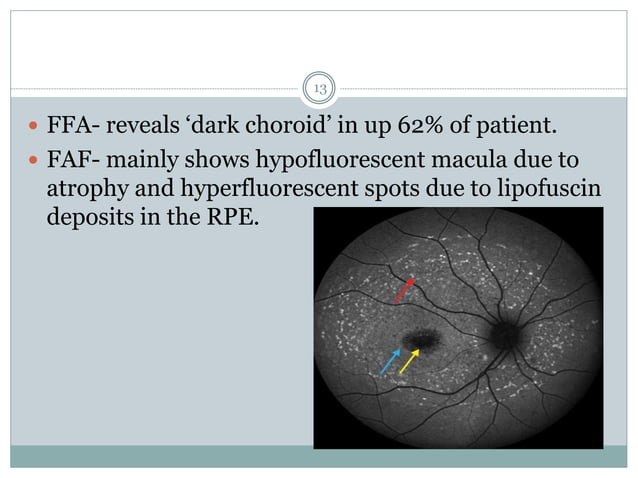Stargardt disease and low vision management. | PPTX | Eye and Vision ...