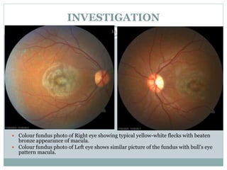 Stargardt disease and low vision management. | PPTX