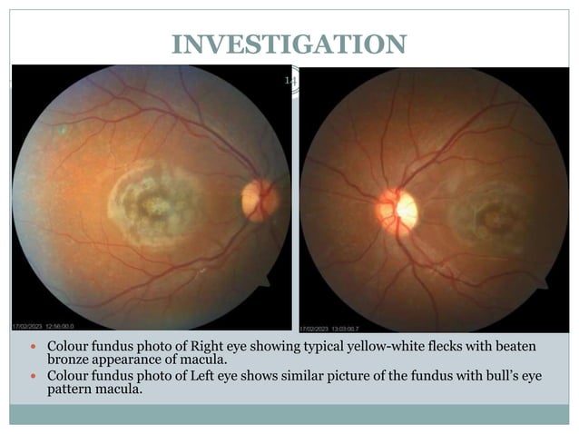 Stargardt disease and low vision management. | PPTX | Eye and Vision ...
