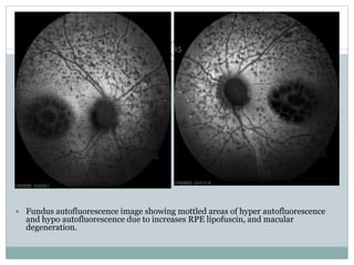 Stargardt disease and low vision management. | PPTX
