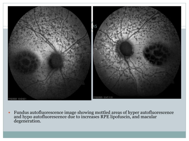 Stargardt disease and low vision management. | PPTX | Eye and Vision ...