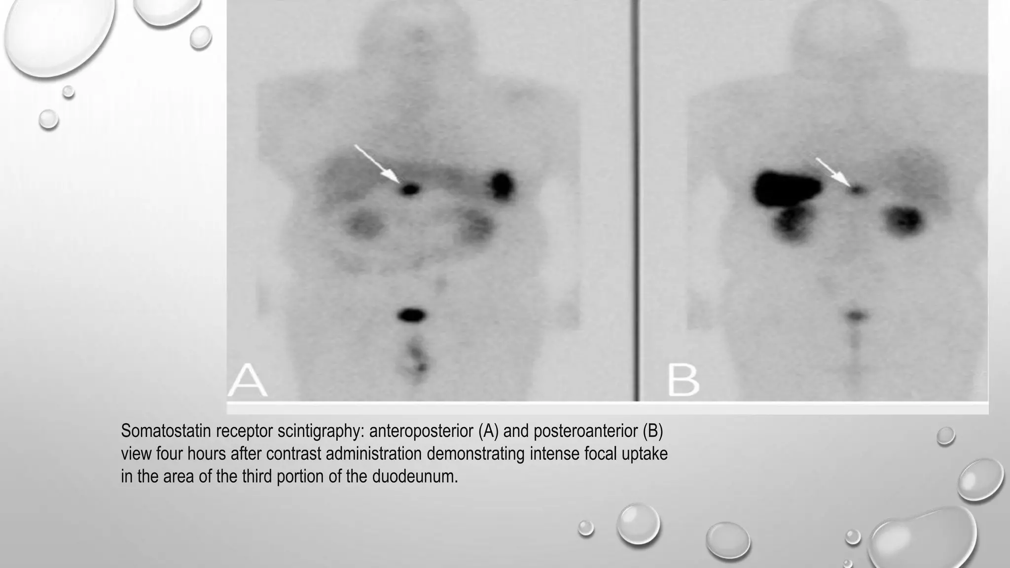 Zollinger Ellison Syndrome | PPTX