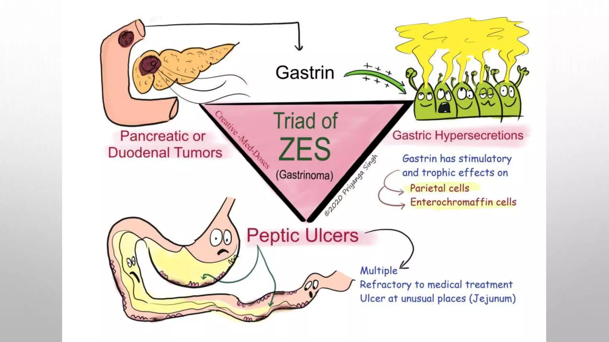 Zollinger Ellison Syndrome | PPTX