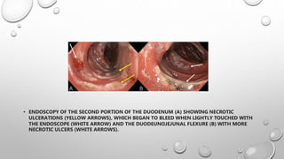Zollinger Ellison Syndrome | PPTX