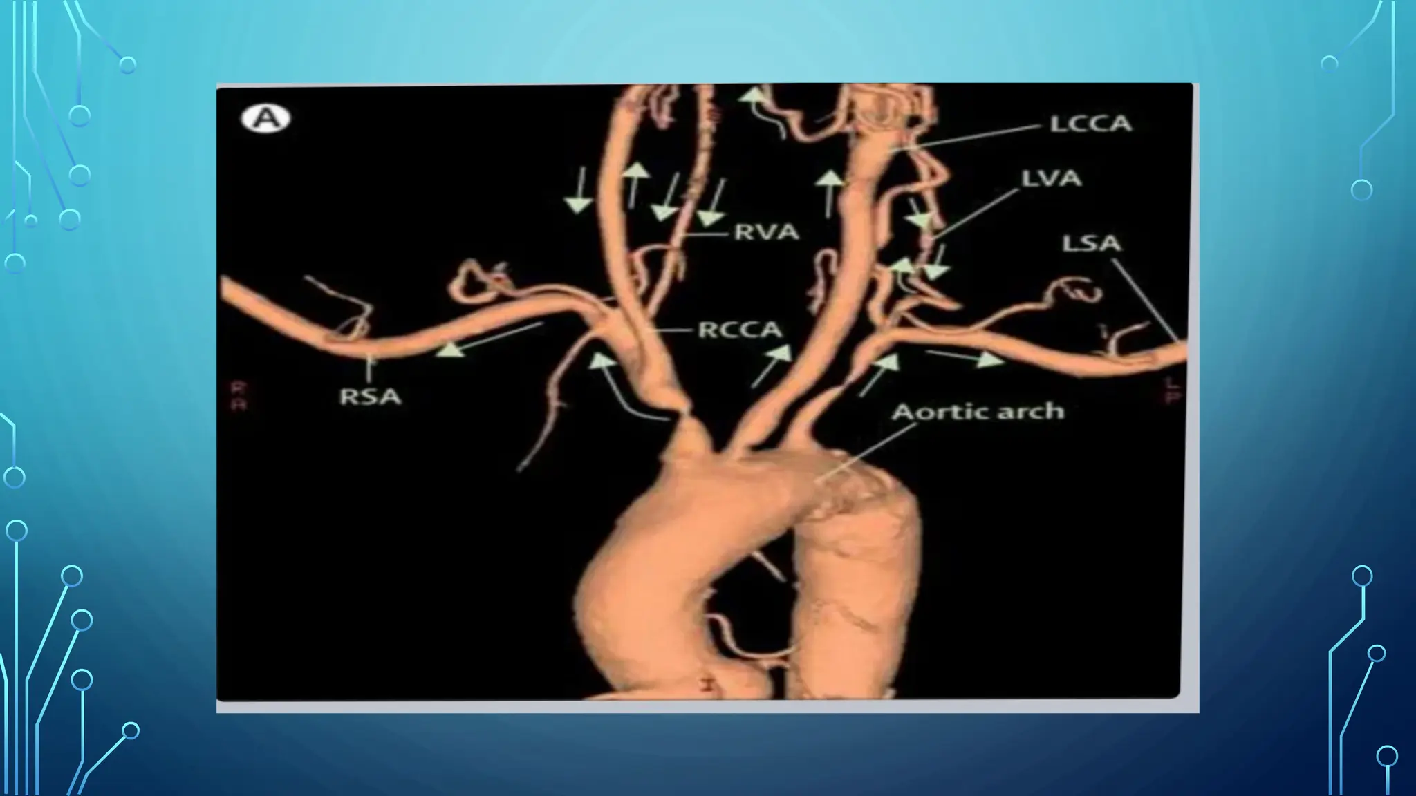 CECT NECK NECK ANGIOGRAPHY CAROTID ANGIOGRAPHY | PDF
