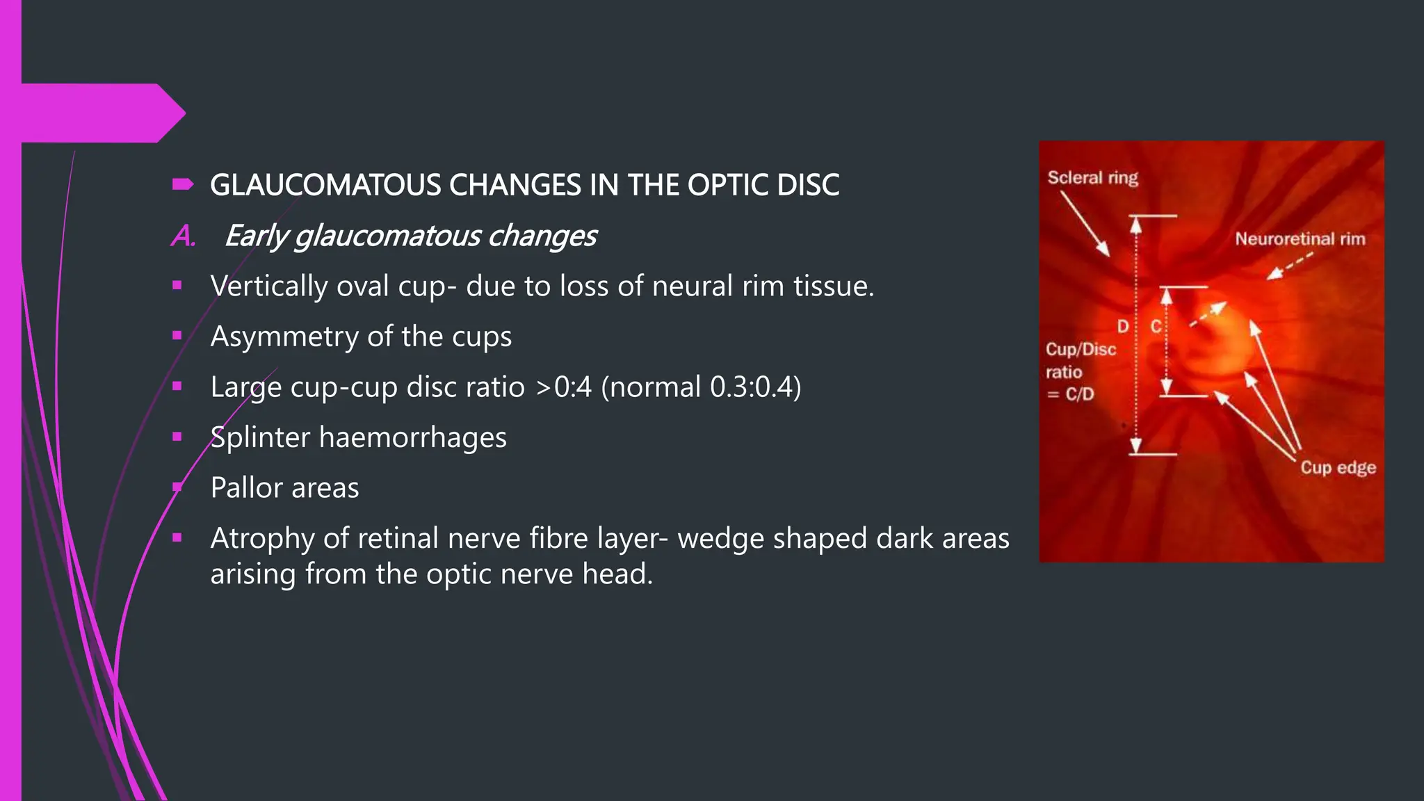 primaary open angle glaucoma presentation | PPTX