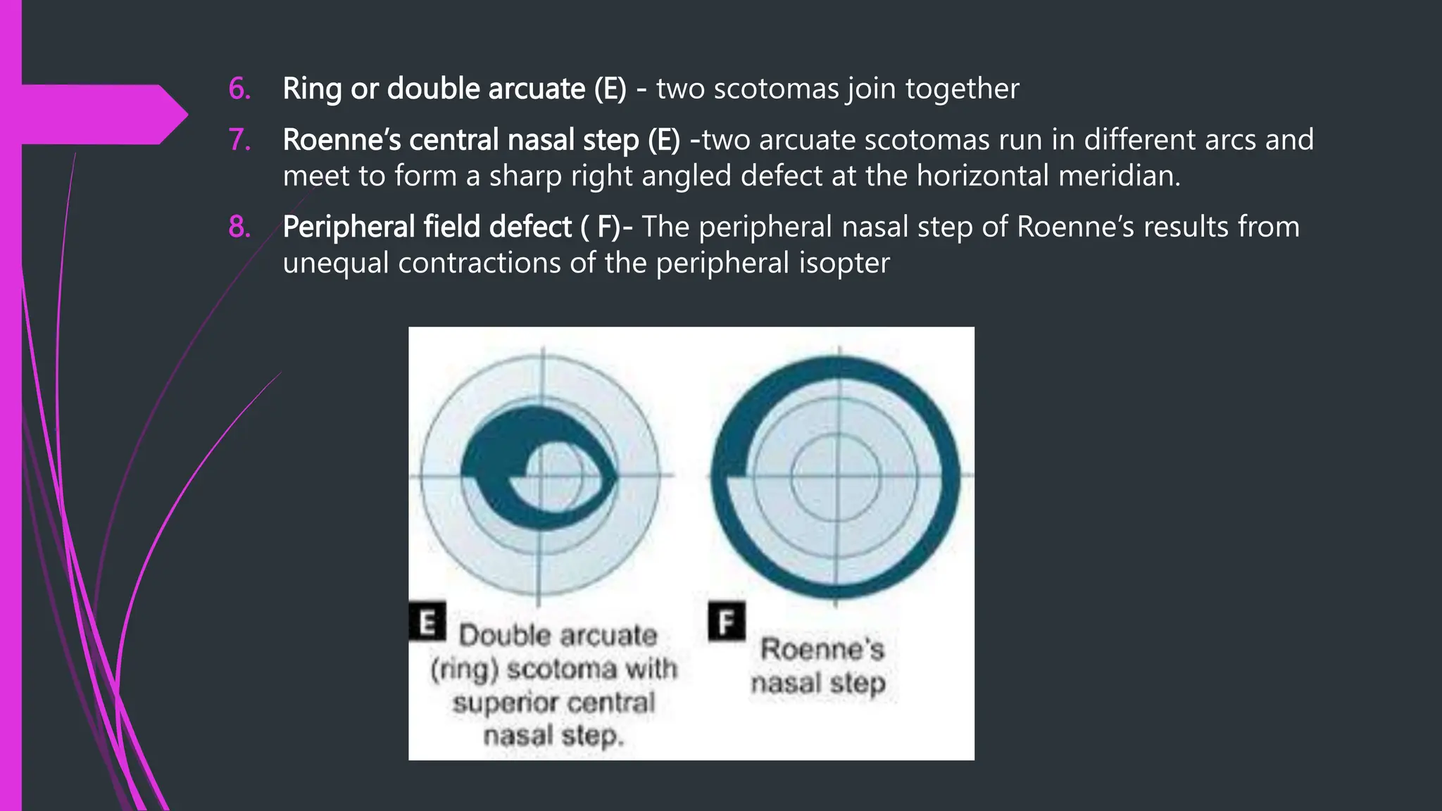 primaary open angle glaucoma presentation | PPTX