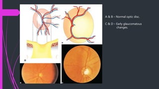 primaary open angle glaucoma presentation | PPTX