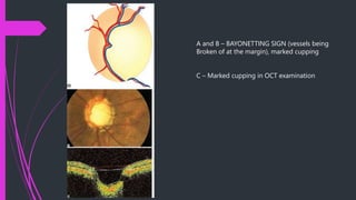 primaary open angle glaucoma presentation | PPTX