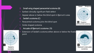 primaary open angle glaucoma presentation | PPTX