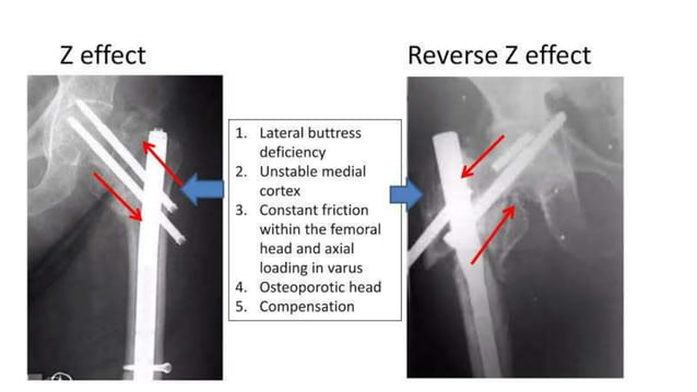 Hemiarthroplasty versus proximal femoral nailing | PPT