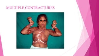 Post burn scar and scar contracture. | PPTX
