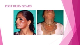 Post burn scar and scar contracture. | PPTX