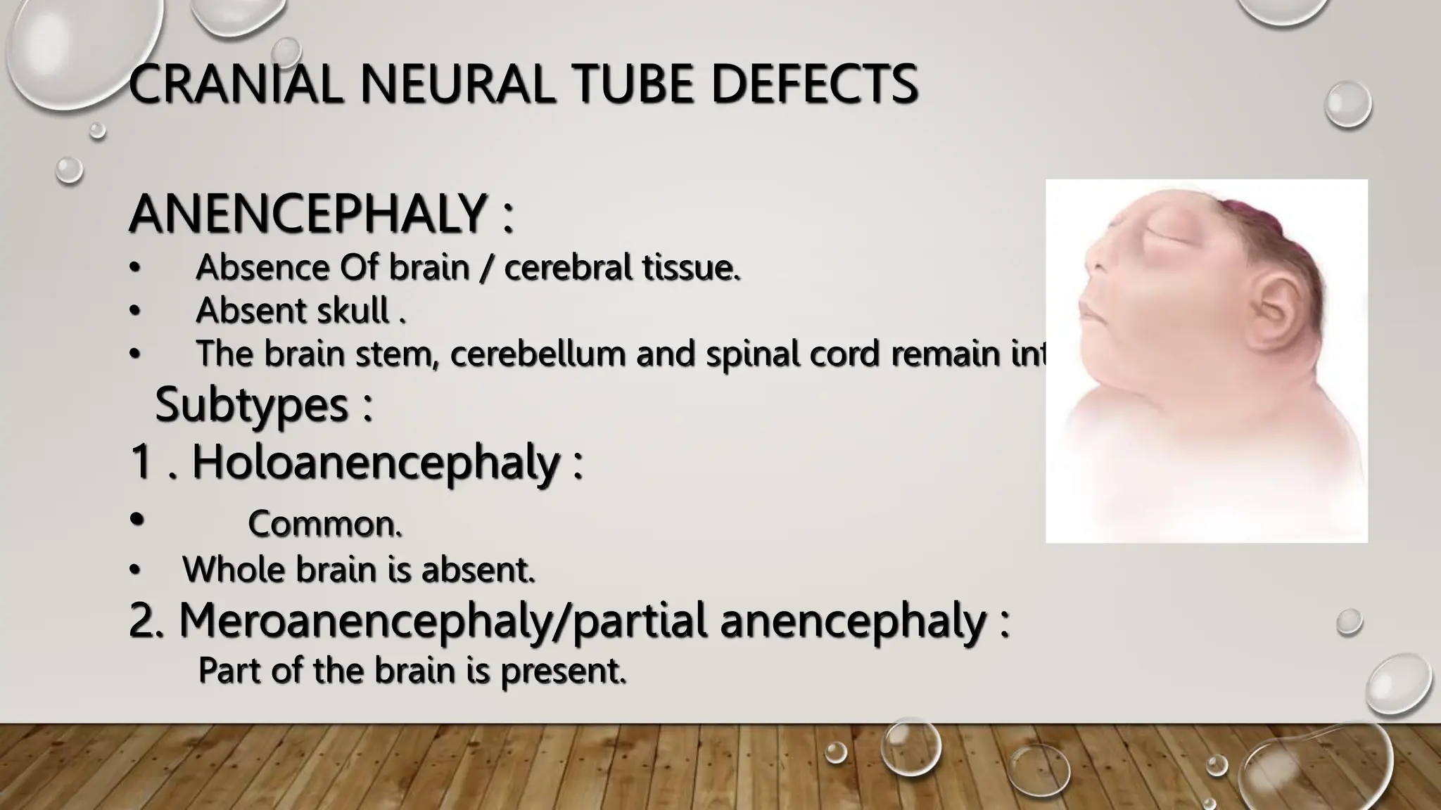 Neural tube defect | PPT
