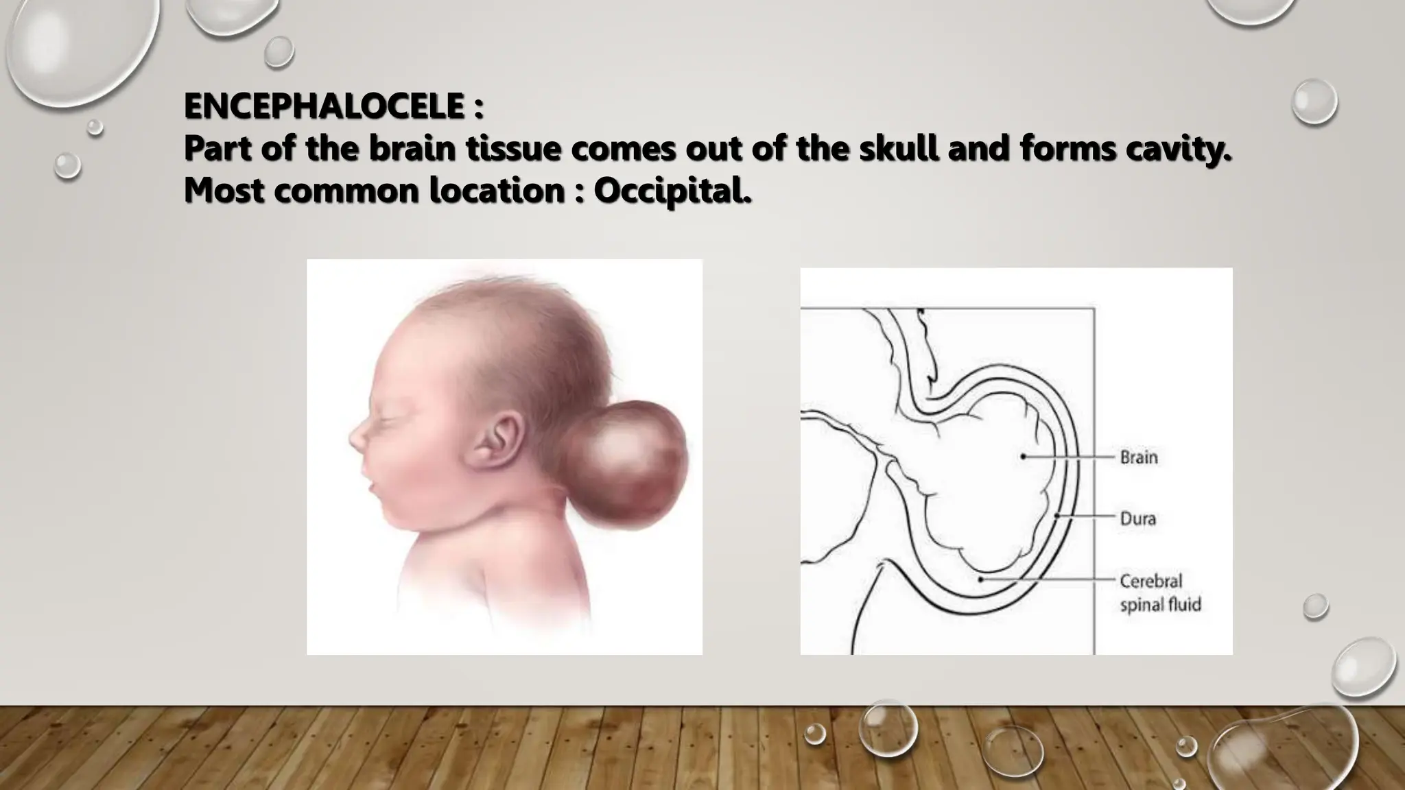 Neural tube defect | PPT