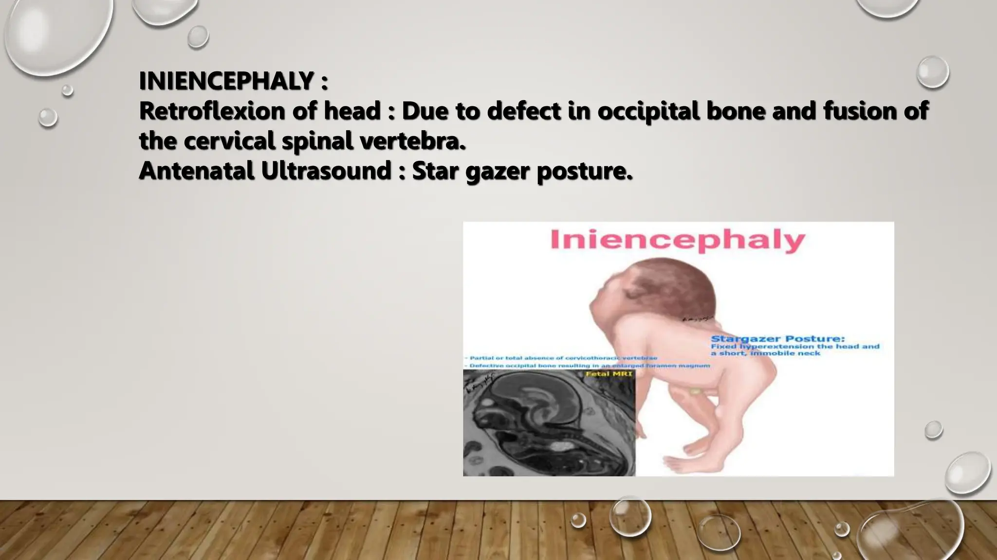 Neural tube defect | PPTX