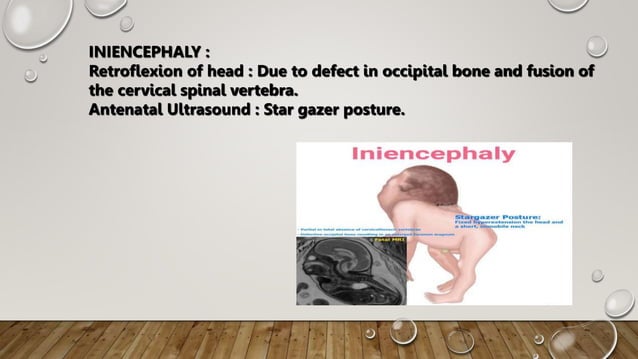 Neural tube defect | PPT