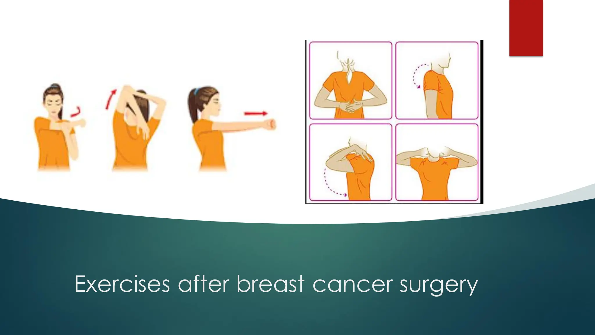 MASTECTOMY PROCEDURES NOTES PRESENTATION | PPT