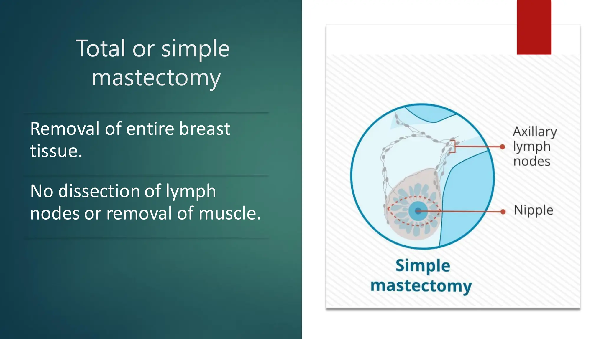 MASTECTOMY PROCEDURES NOTES PRESENTATION | PPT