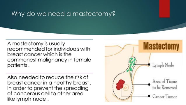 MASTECTOMY PROCEDURES NOTES PRESENTATION | PPT