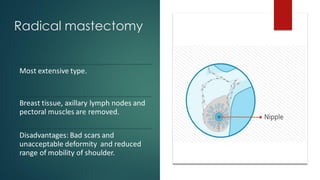 MASTECTOMY PROCEDURES NOTES PRESENTATION | PPT
