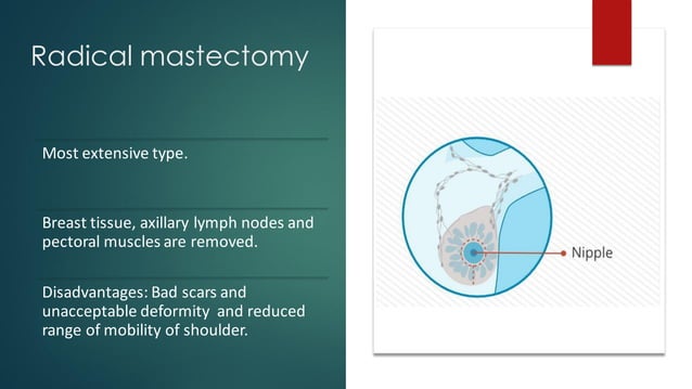 MASTECTOMY PROCEDURES NOTES PRESENTATION | PPT