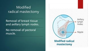 MASTECTOMY PROCEDURES NOTES PRESENTATION | PPT