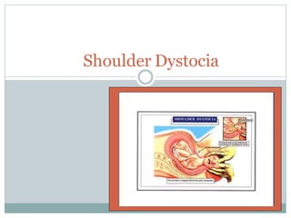DOC-20240114-WA0004 shoulder dystocia..pptx
