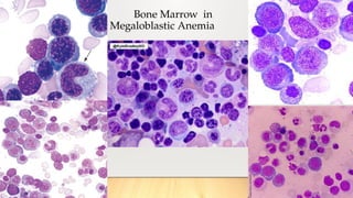 DOC-20240321-WA0000..pptx iron deficiency anemia | PPTX