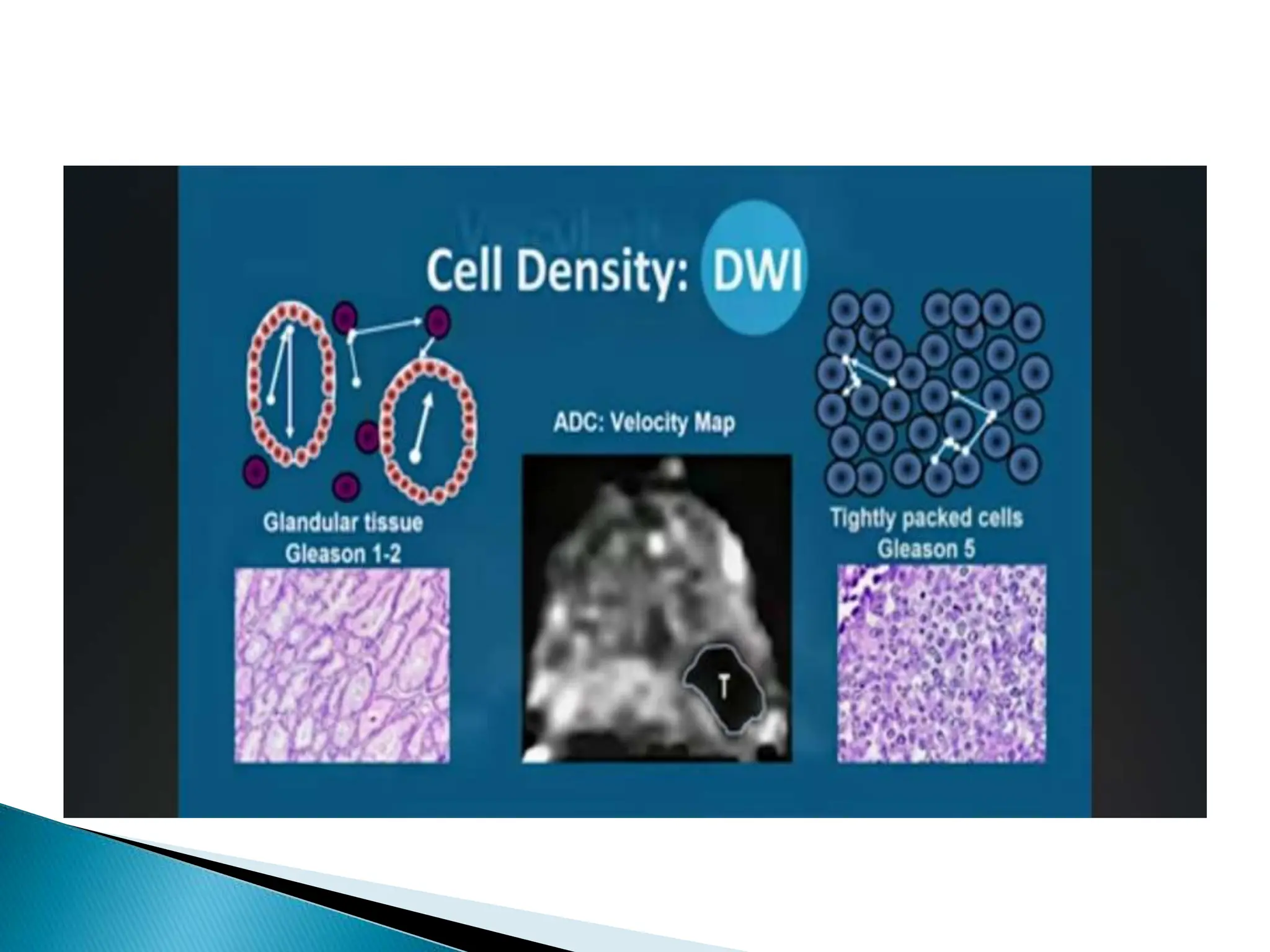 Diagnosis, Staging and Management of CA Prostate | PPT